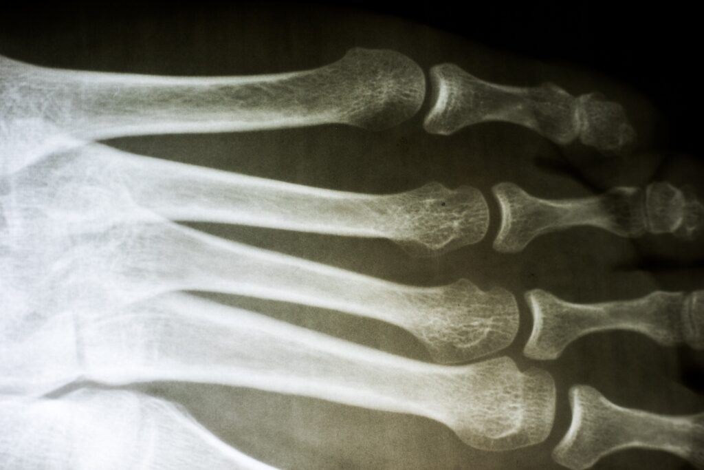 Colorado Bone Fractures Lawyer - Lerner and Rowe Injury Attorneys