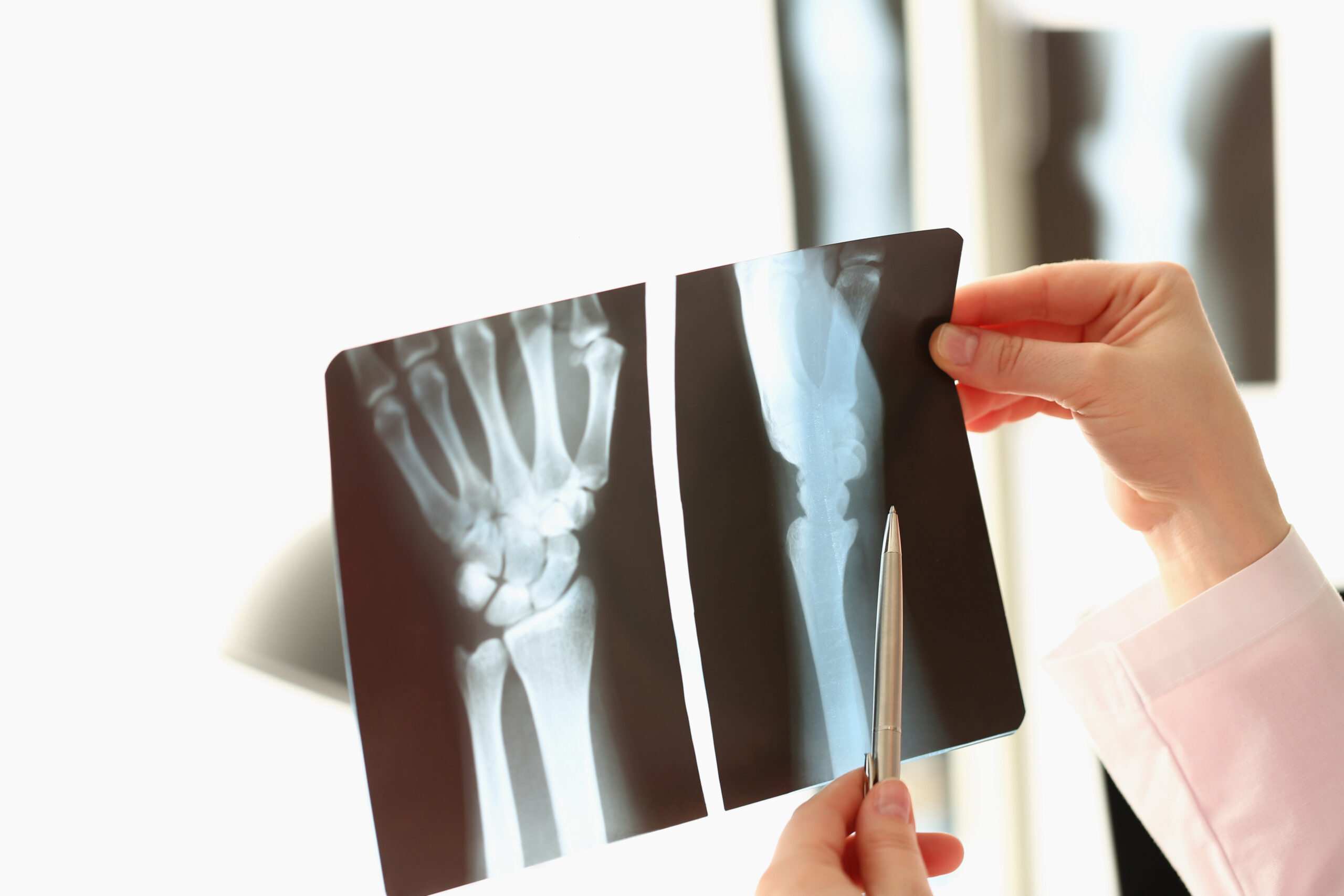 Silver Springs Bone Fractures Lawyer - Lerner and Rowe Injury Attorneys