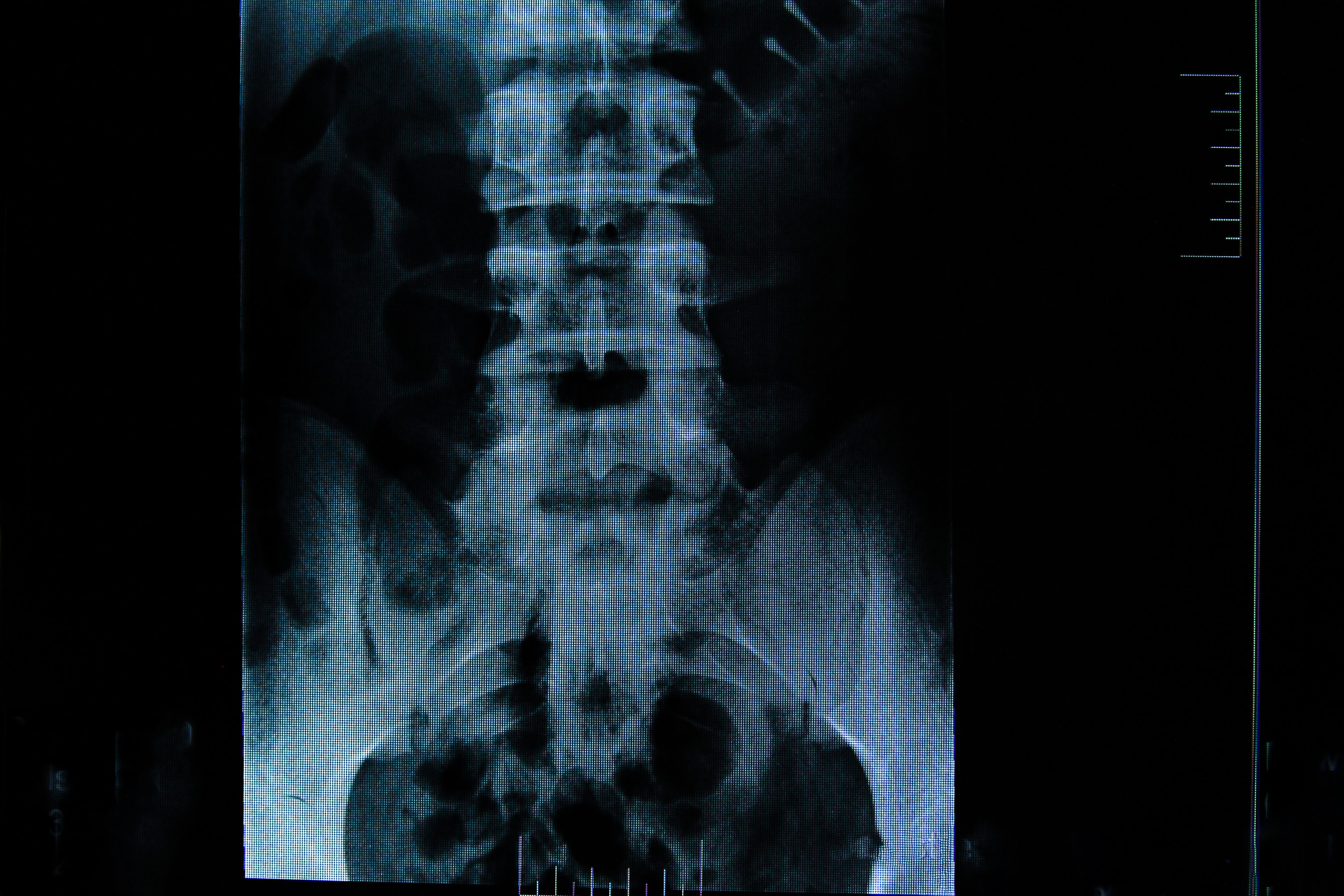 Hawthorne Spinal Injury Lawyer - Lerner and Rowe Injury Attorneys